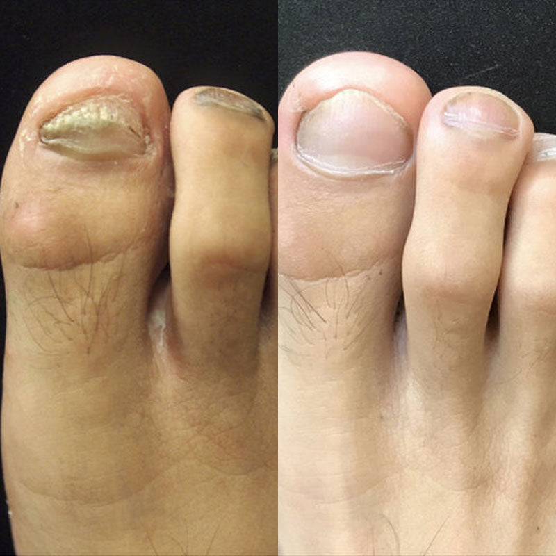 Nail Fungus Treatment Gel – NutraBoost